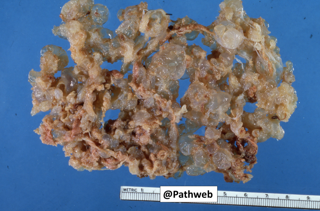 Uterus with Tubal Ectopic and Hydatidiform Mole – NUS Pathweb :: NUS ...