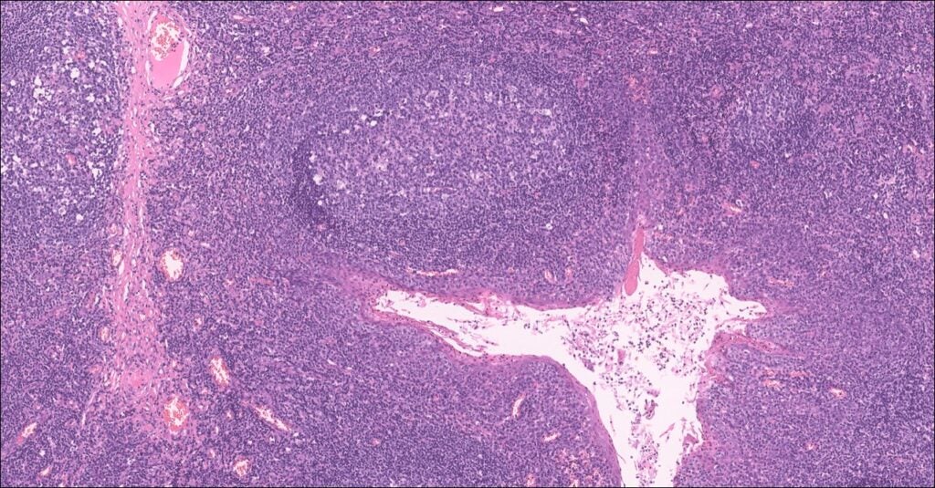 Tonsil – Normal Histology – NUS Pathweb :: NUS Pathweb
