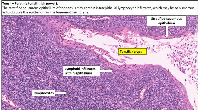 Tonsil – Normal Histology – NUS Pathweb :: NUS Pathweb