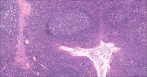 Tonsil – Normal Histology – NUS Pathweb :: NUS Pathweb