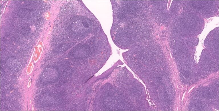 Tonsil – Normal Histology – NUS Pathweb :: NUS Pathweb