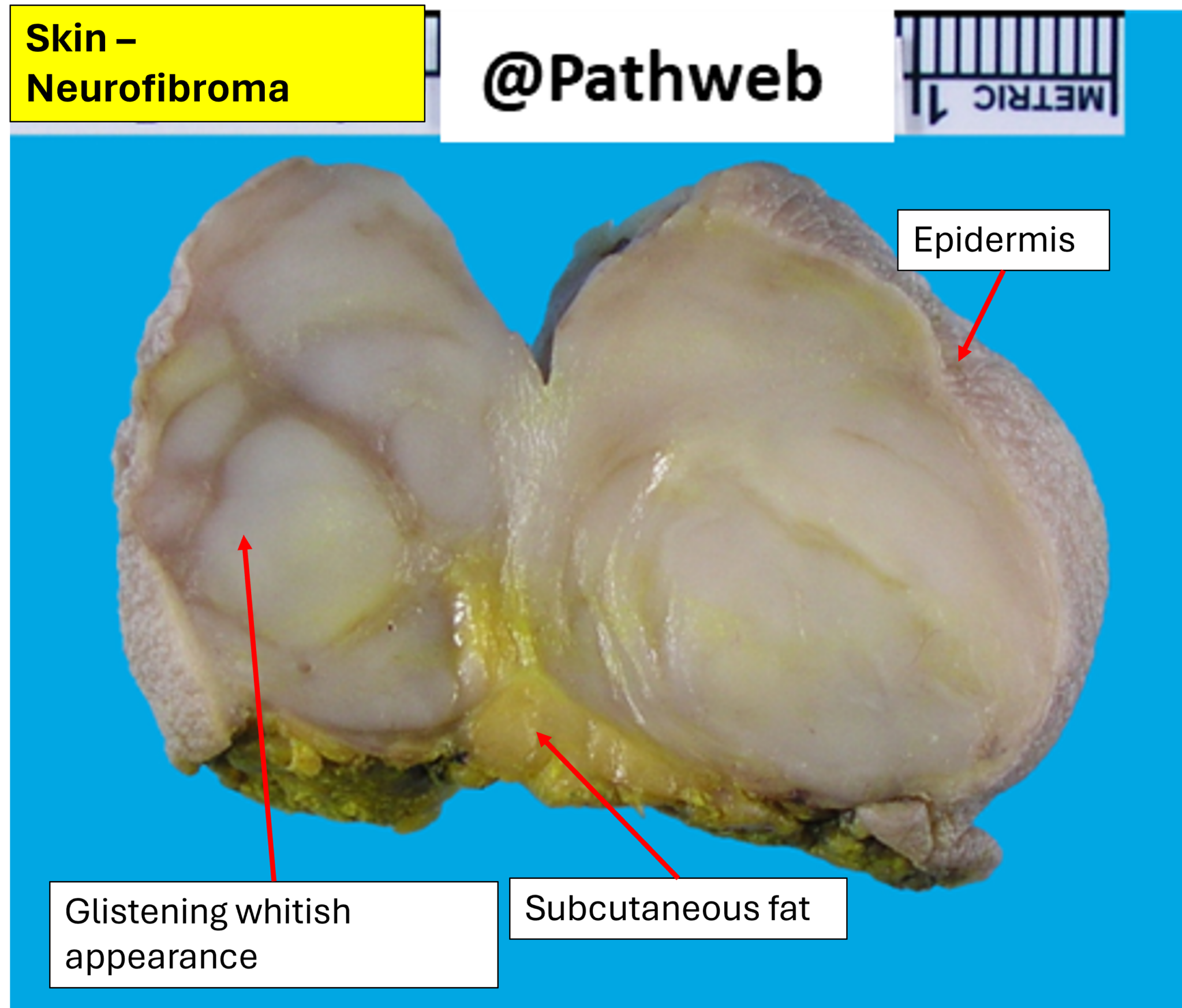 Skin – Neurofibroma – NUS Pathweb :: NUS Pathweb