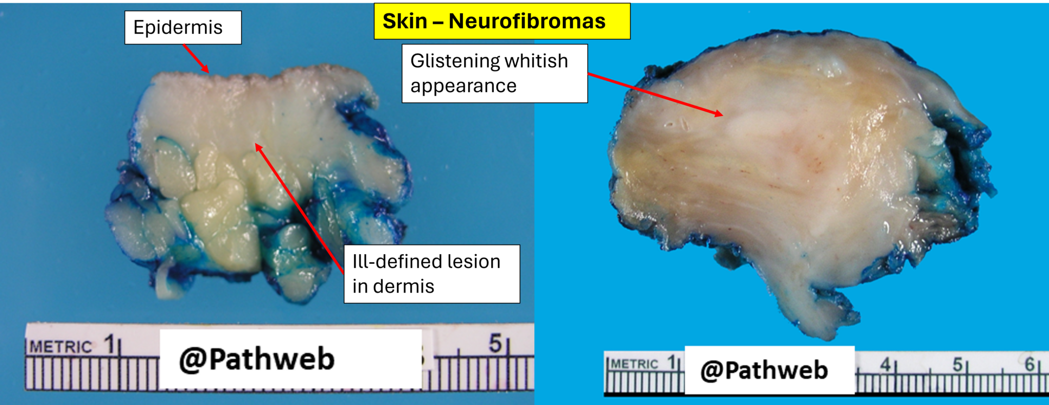 Skin – Neurofibroma – NUS Pathweb :: NUS Pathweb