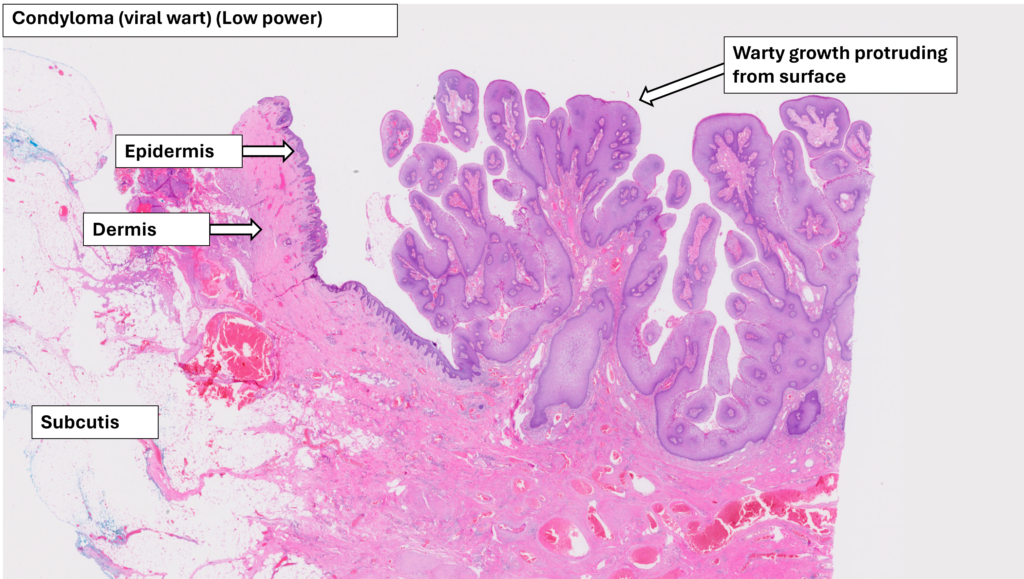 Penis – Wart (Condyloma acuminatum) – NUS Pathweb :: NUS Pathweb