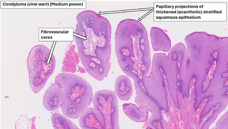 Skin – Condyloma – NUS Pathweb :: NUS Pathweb