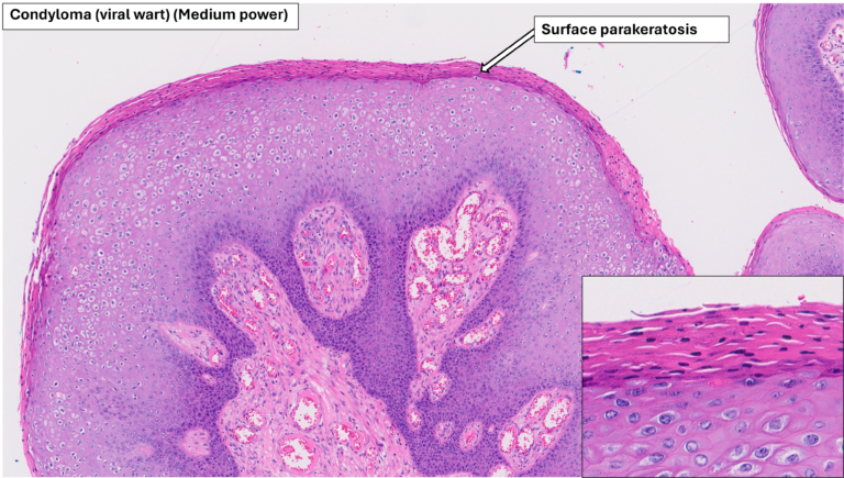 Penis – Wart (Condyloma acuminatum) – NUS Pathweb :: NUS Pathweb