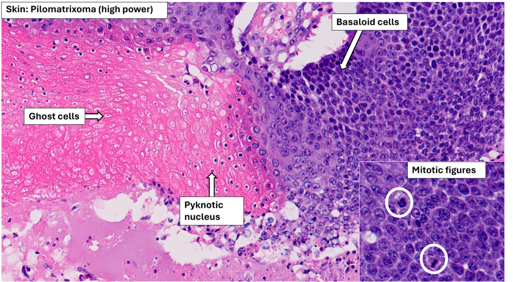 Skin – Pilomatrixoma – NUS Pathweb :: NUS Pathweb