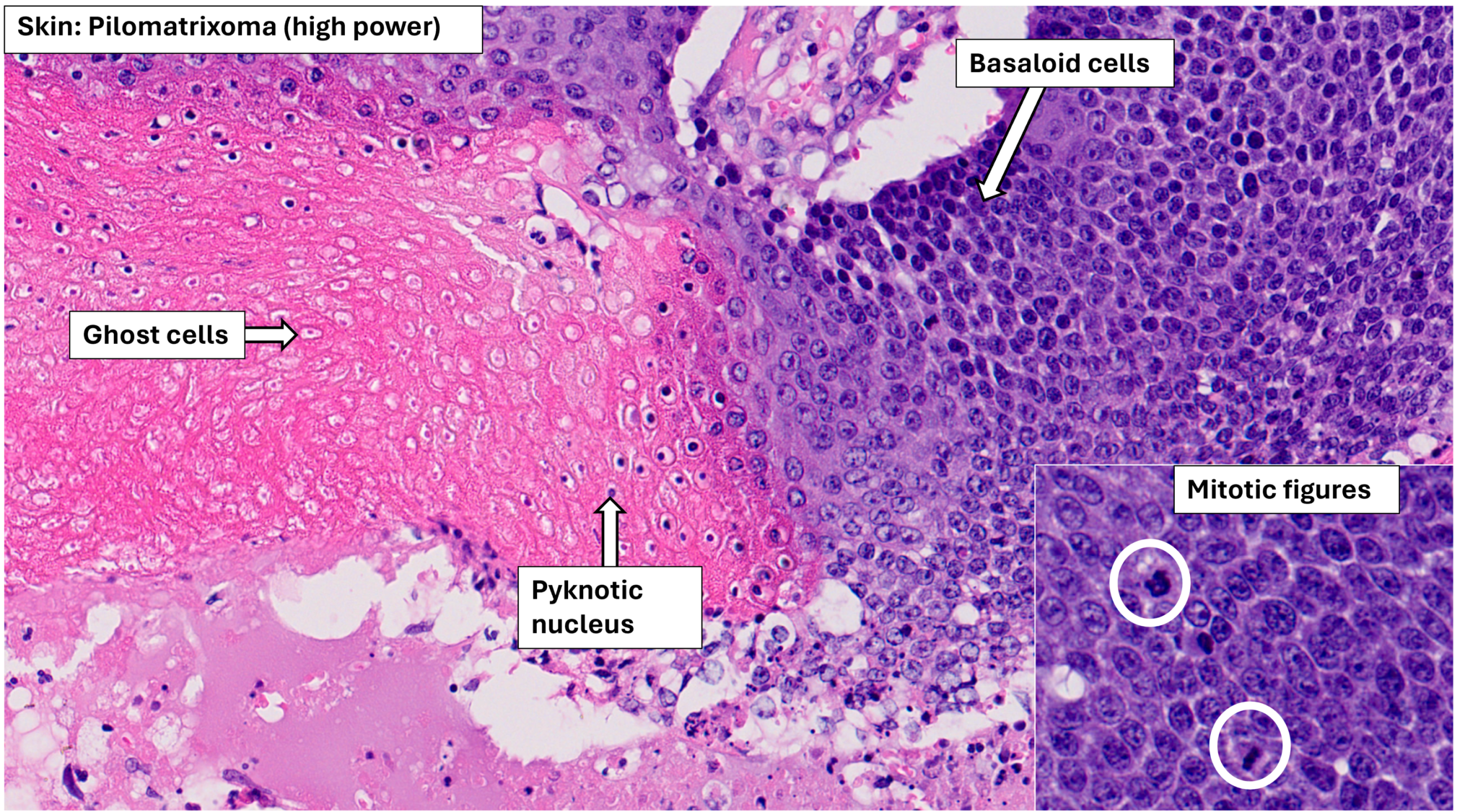 Skin – Pilomatrixoma – NUS Pathweb :: NUS Pathweb