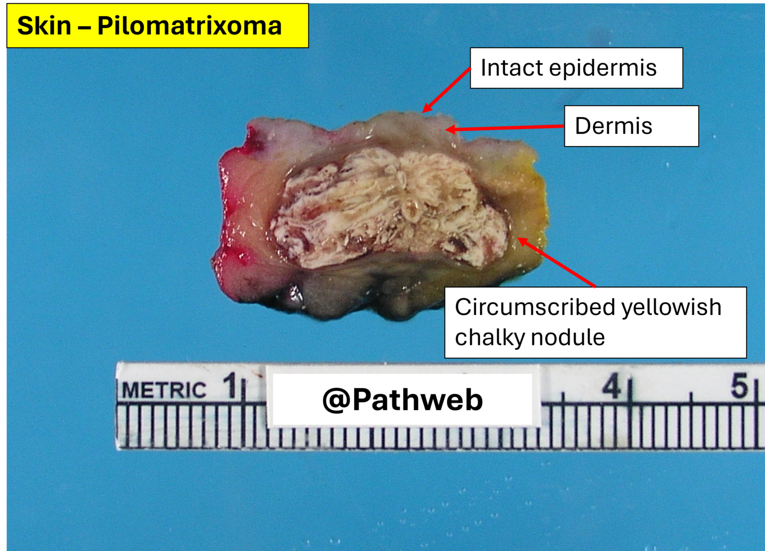 Skin – Pilomatrixoma – NUS Pathweb :: NUS Pathweb