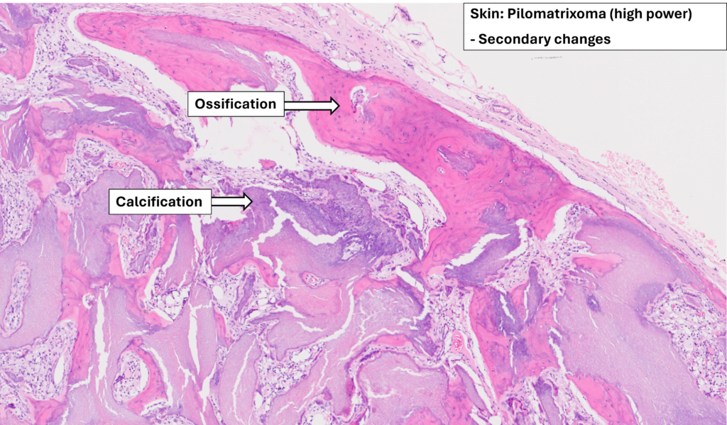 Skin – Pilomatrixoma – NUS Pathweb :: NUS Pathweb