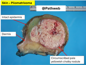 Skin – Pilomatrixoma – NUS Pathweb :: NUS Pathweb
