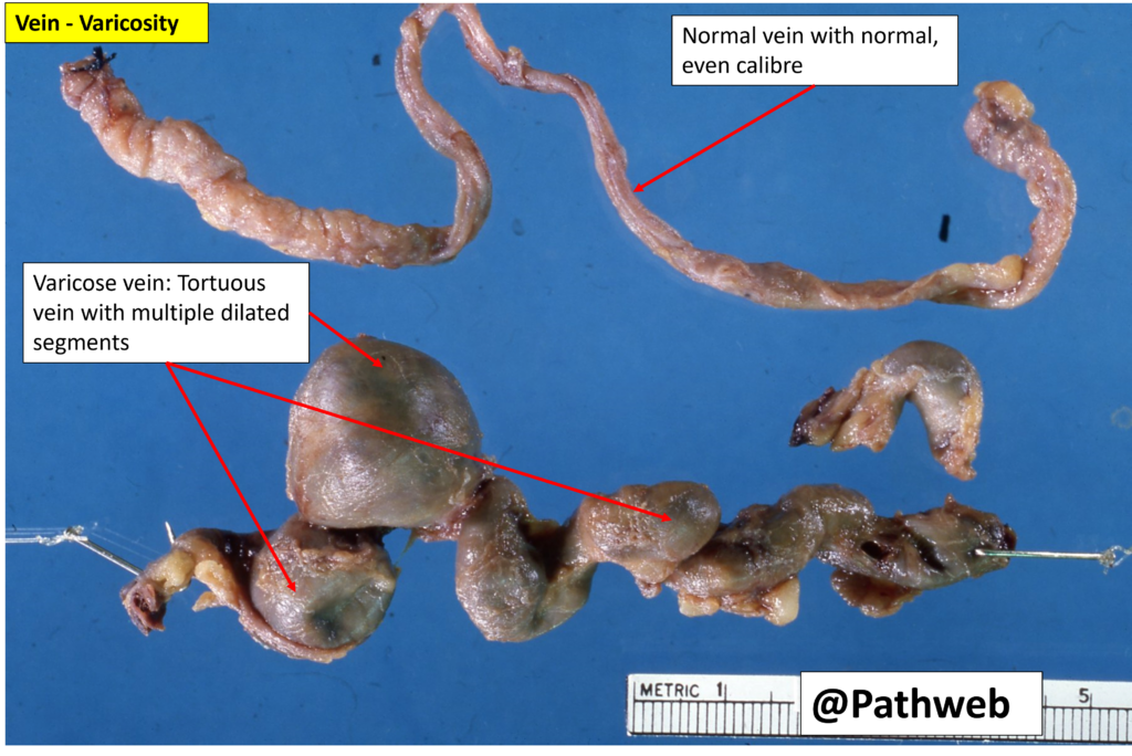 Vein – Varicosity – NUS Pathweb :: NUS Pathweb