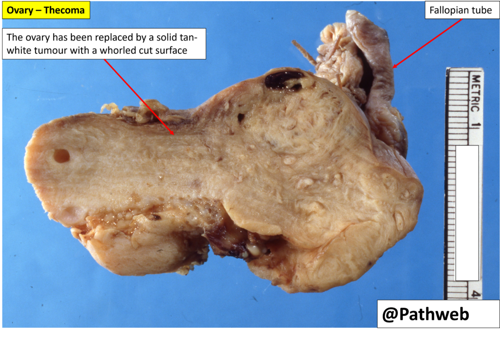 Ovary – Thecoma – NUS Pathweb :: NUS Pathweb