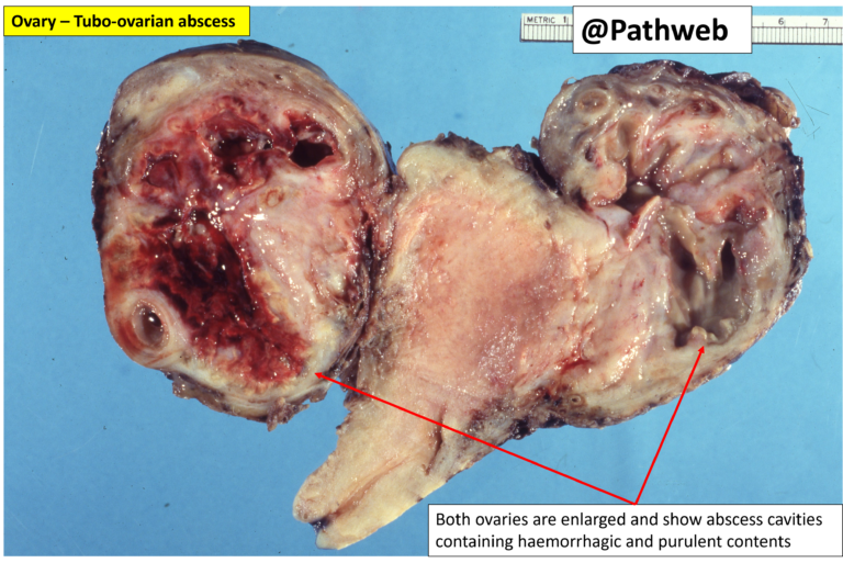 Fallopian Tube / Ovary – Tubo-ovarian Abscess – NUS Pathweb :: NUS Pathweb