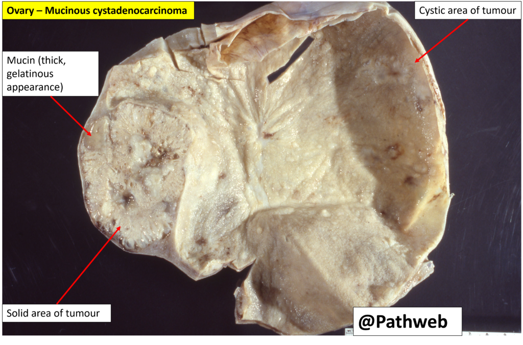 Ovary – Mucinous carcinoma (Mucinous cystadenocarcinoma) – NUS Pathweb ...