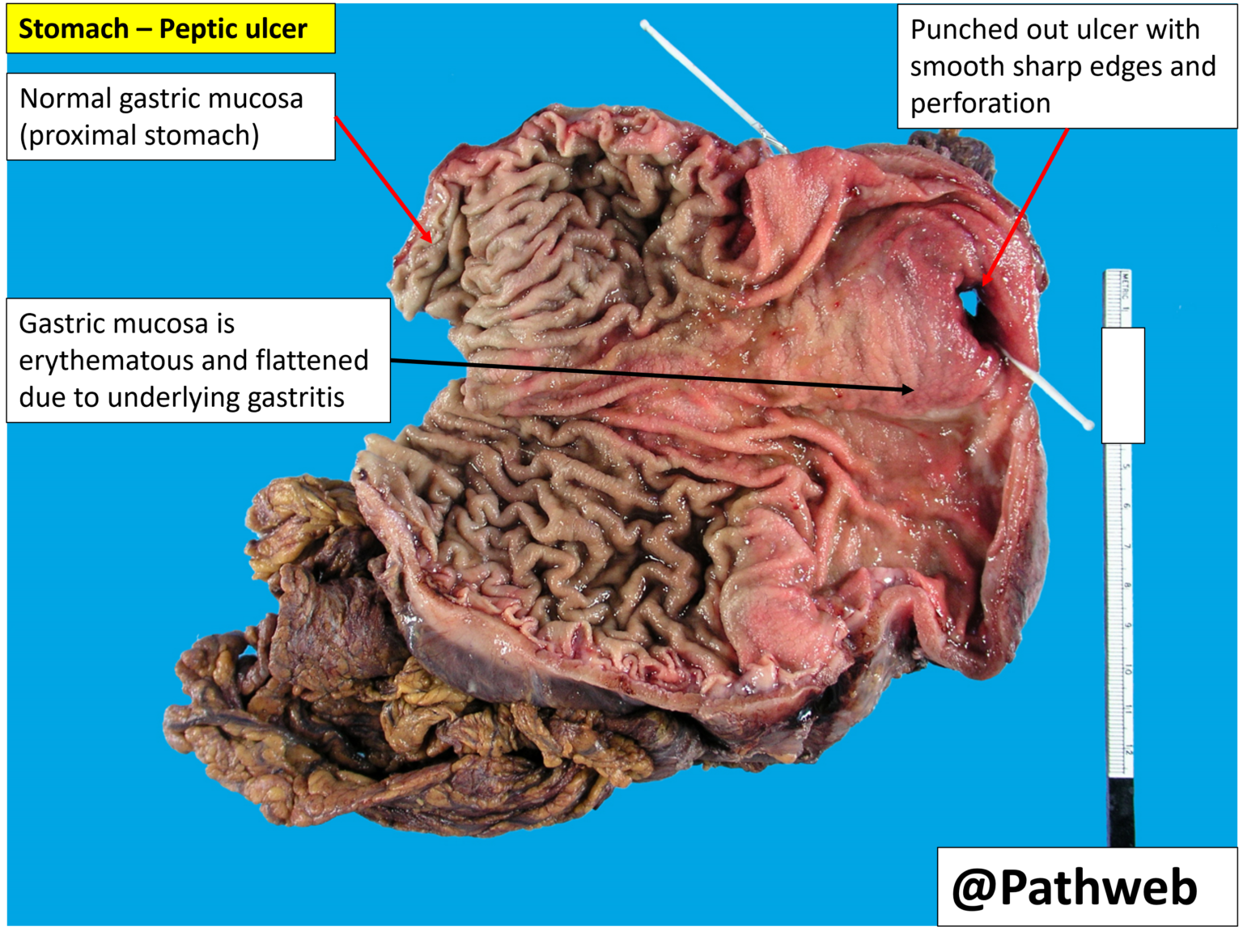 Stomach – Chronic peptic ulcer – NUS Pathweb :: NUS Pathweb
