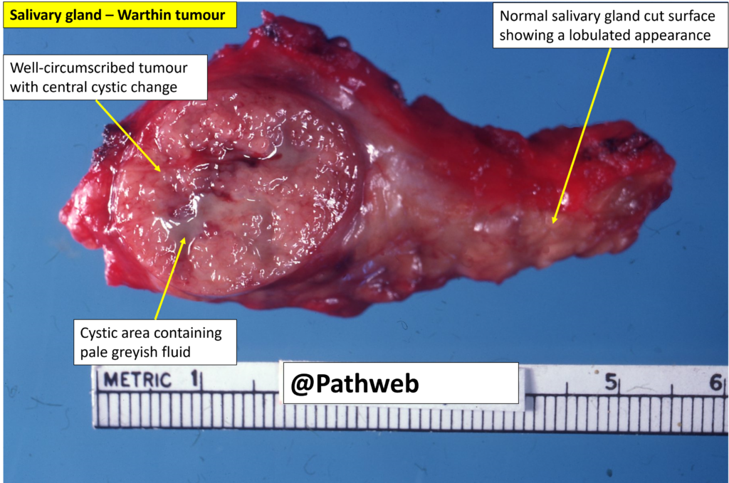 Salivary Gland – Warthin Tumour – NUS Pathweb :: NUS Pathweb