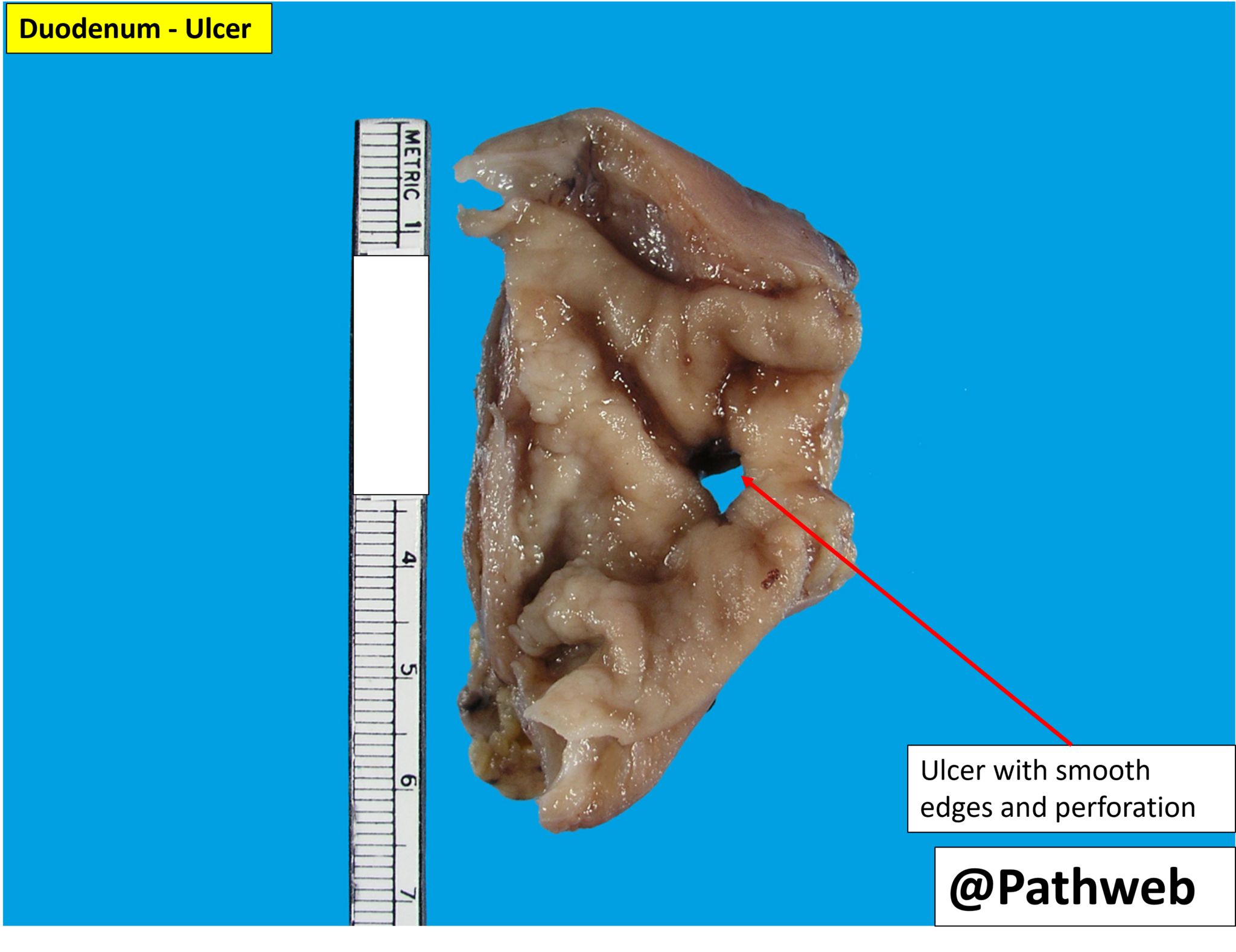 Duodenum – Multiple ulcers – NUS Pathweb :: NUS Pathweb