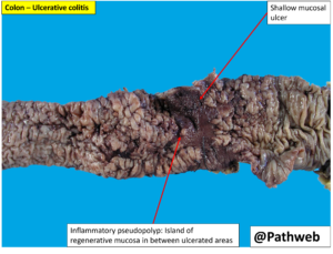 Colon – Ulcerative Colitis – NUS Pathweb :: NUS Pathweb