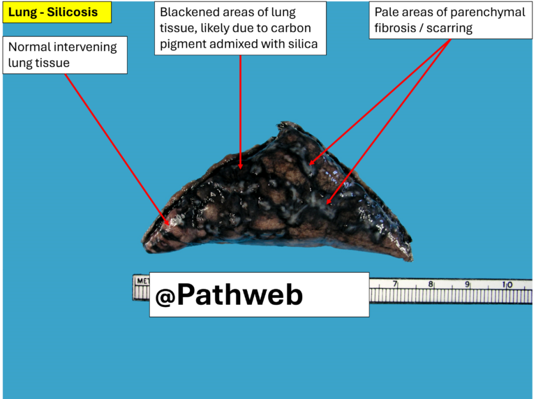 Lung – Silicosis – NUS Pathweb :: NUS Pathweb