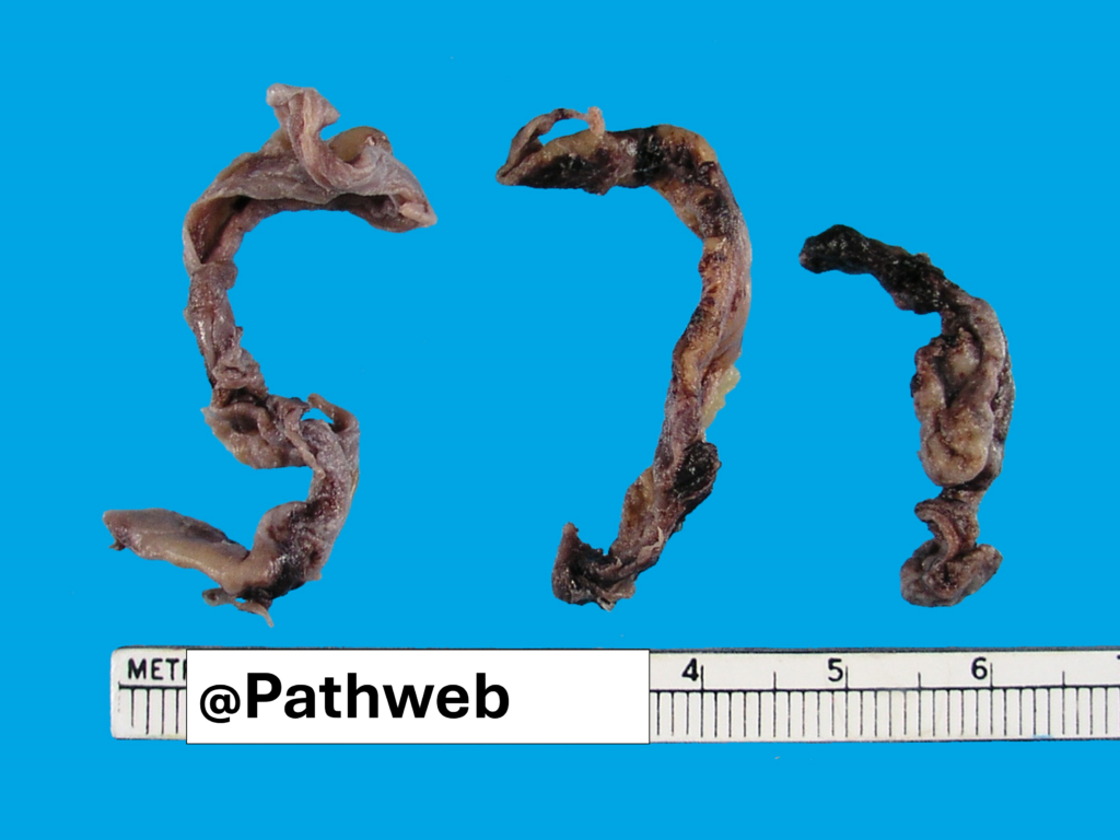 Lung – Healed Pleuritis – NUS Pathweb :: NUS Pathweb