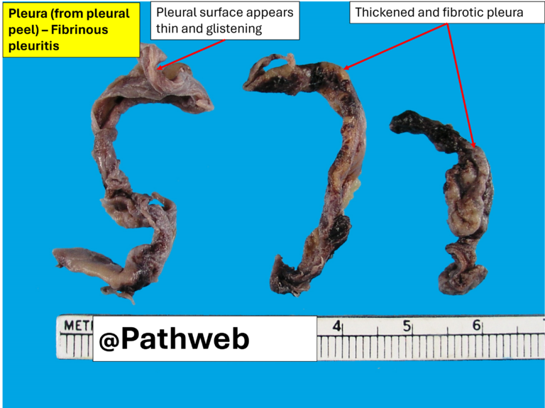 Lung – Healed Pleuritis – NUS Pathweb :: NUS Pathweb