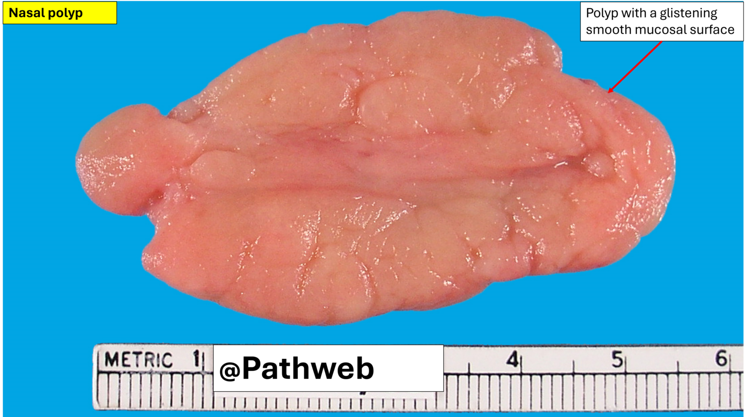Nasal Tissue – Polyp – NUS Pathweb :: NUS Pathweb