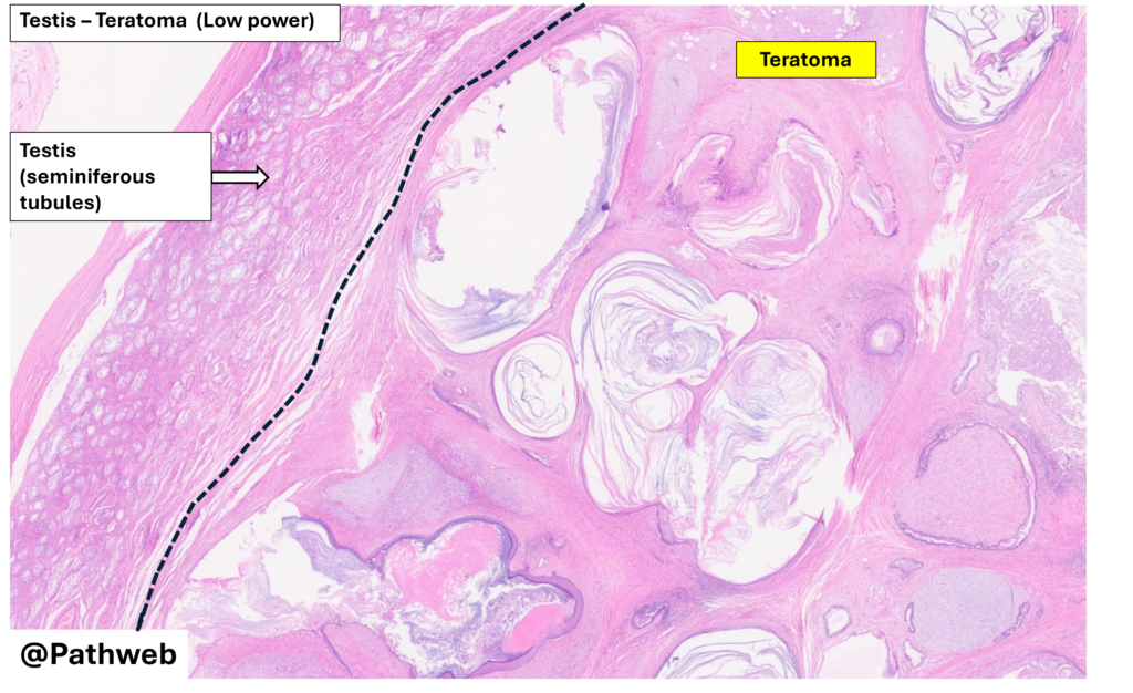 Testis – Teratoma – NUS Pathweb :: NUS Pathweb