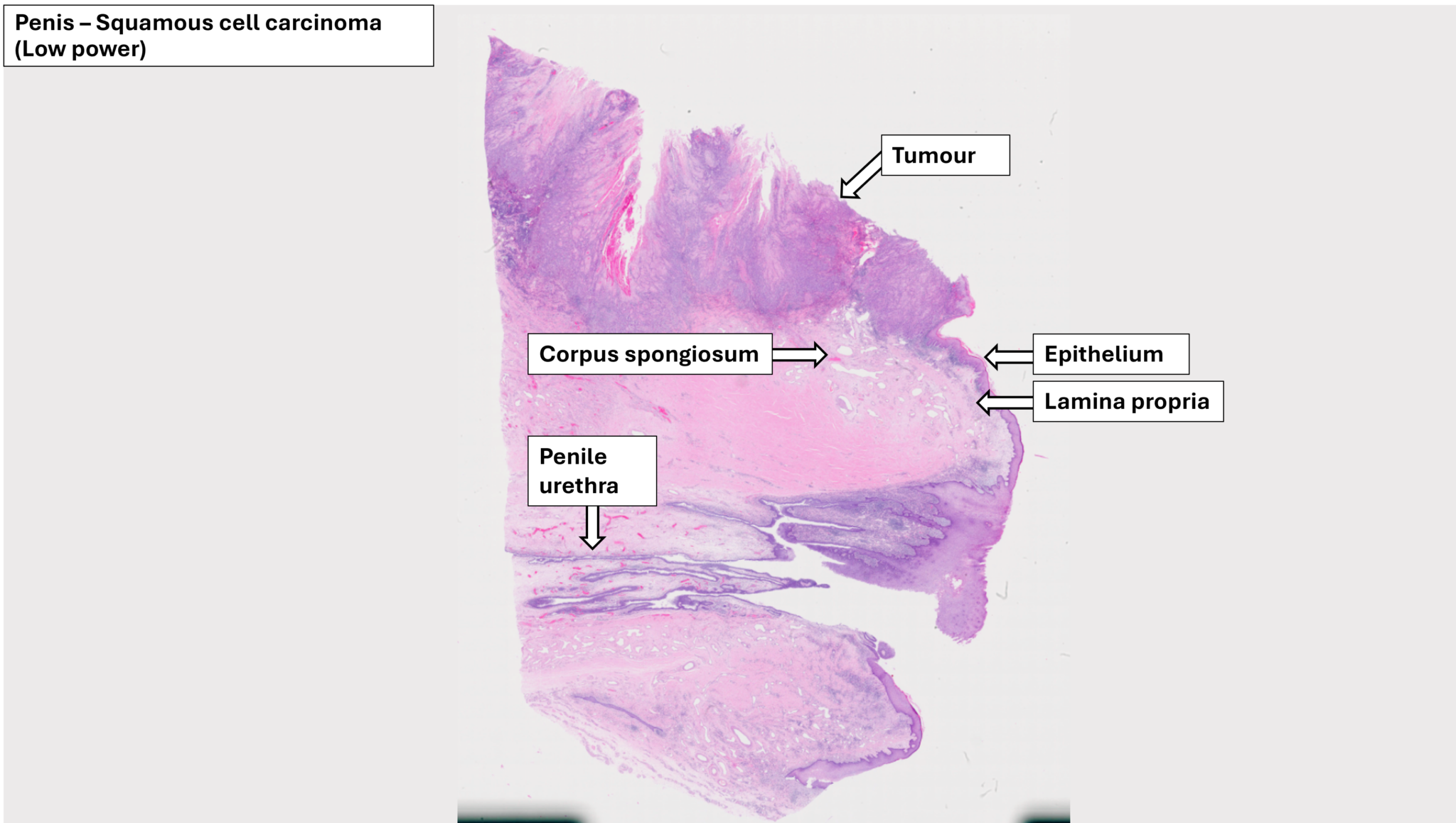 Penis – Squamous Cell Carcinoma – NUS Pathweb :: NUS Pathweb