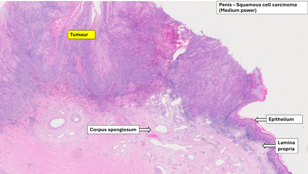 Penis – Squamous Cell Carcinoma – NUS Pathweb :: NUS Pathweb
