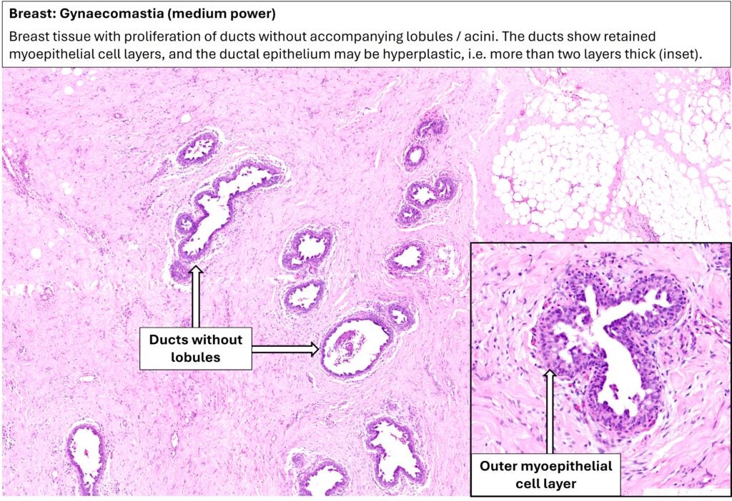 Breast (Male) – Gynaecomastia – NUS Pathweb :: NUS Pathweb
