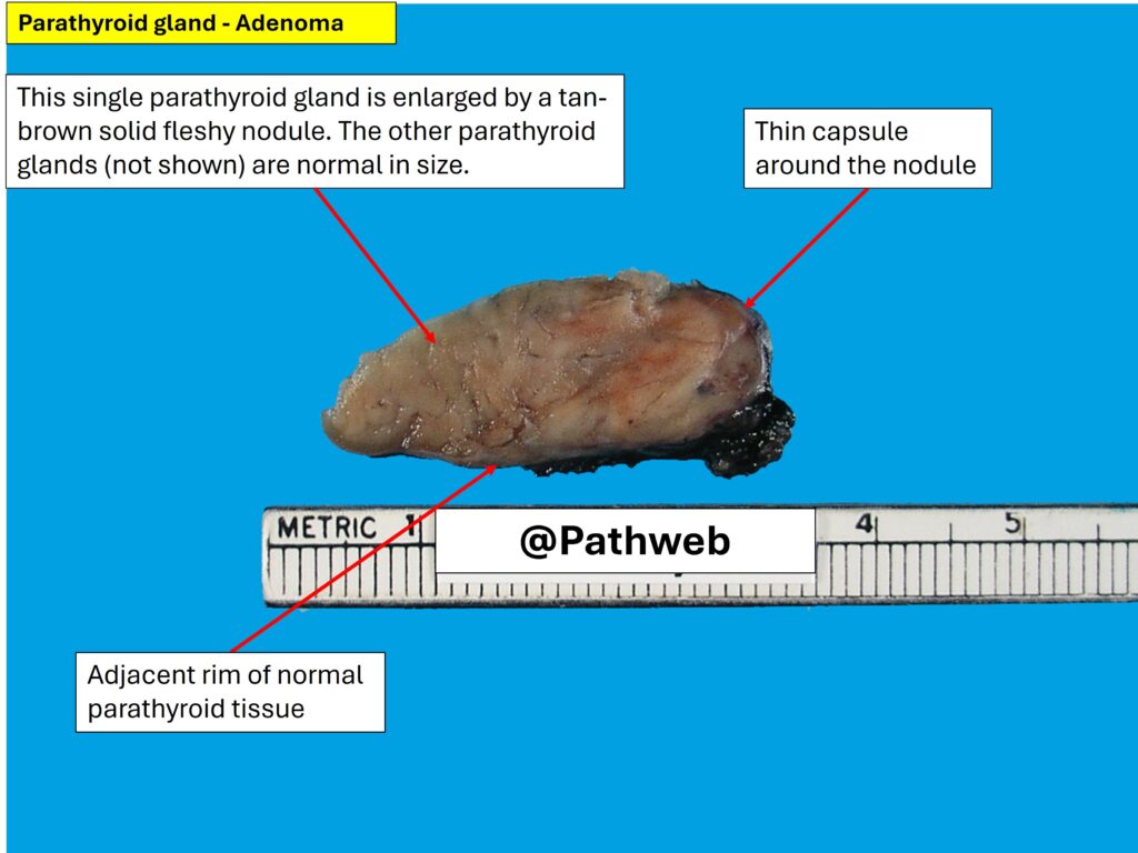 Parathyroid – Adenoma – NUS Pathweb :: NUS Pathweb
