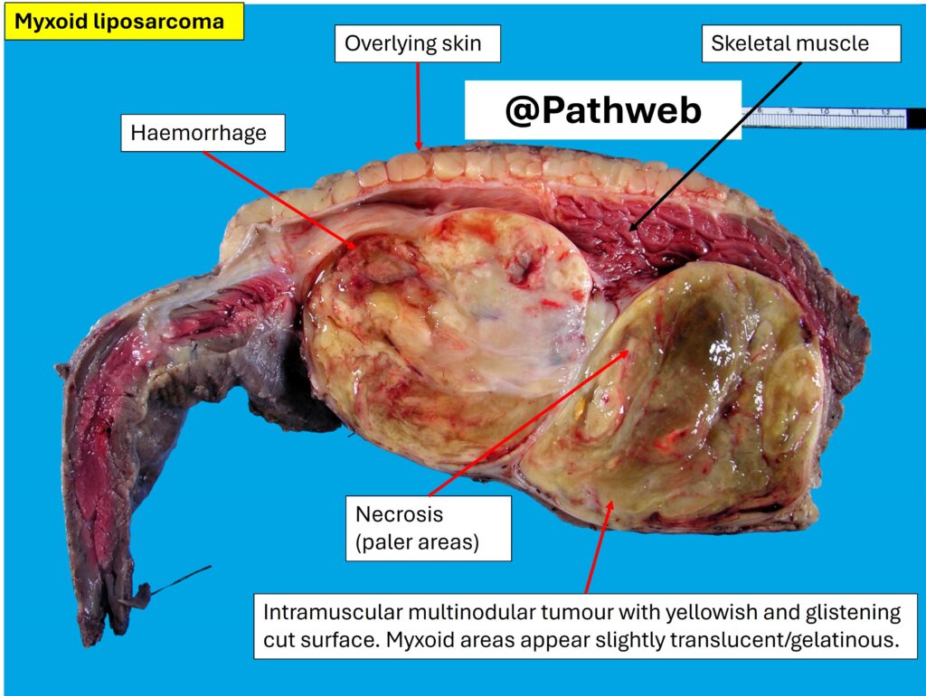 Thigh – Liposarcoma, myxoid – NUS Pathweb :: NUS Pathweb