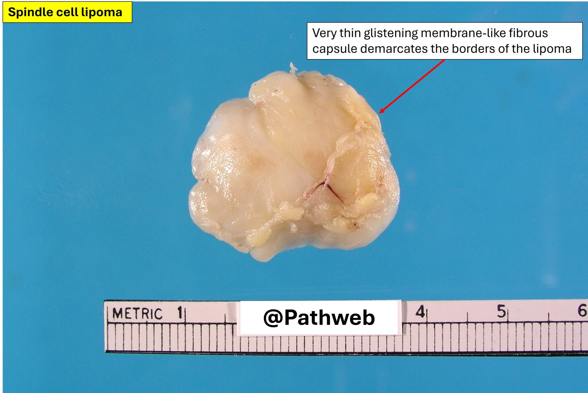 Skin – Lipoma – NUS Pathweb :: NUS Pathweb
