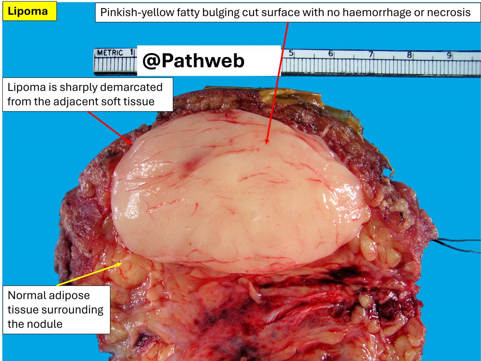Skin(Thigh) – Lipoma – NUS Pathweb :: NUS Pathweb