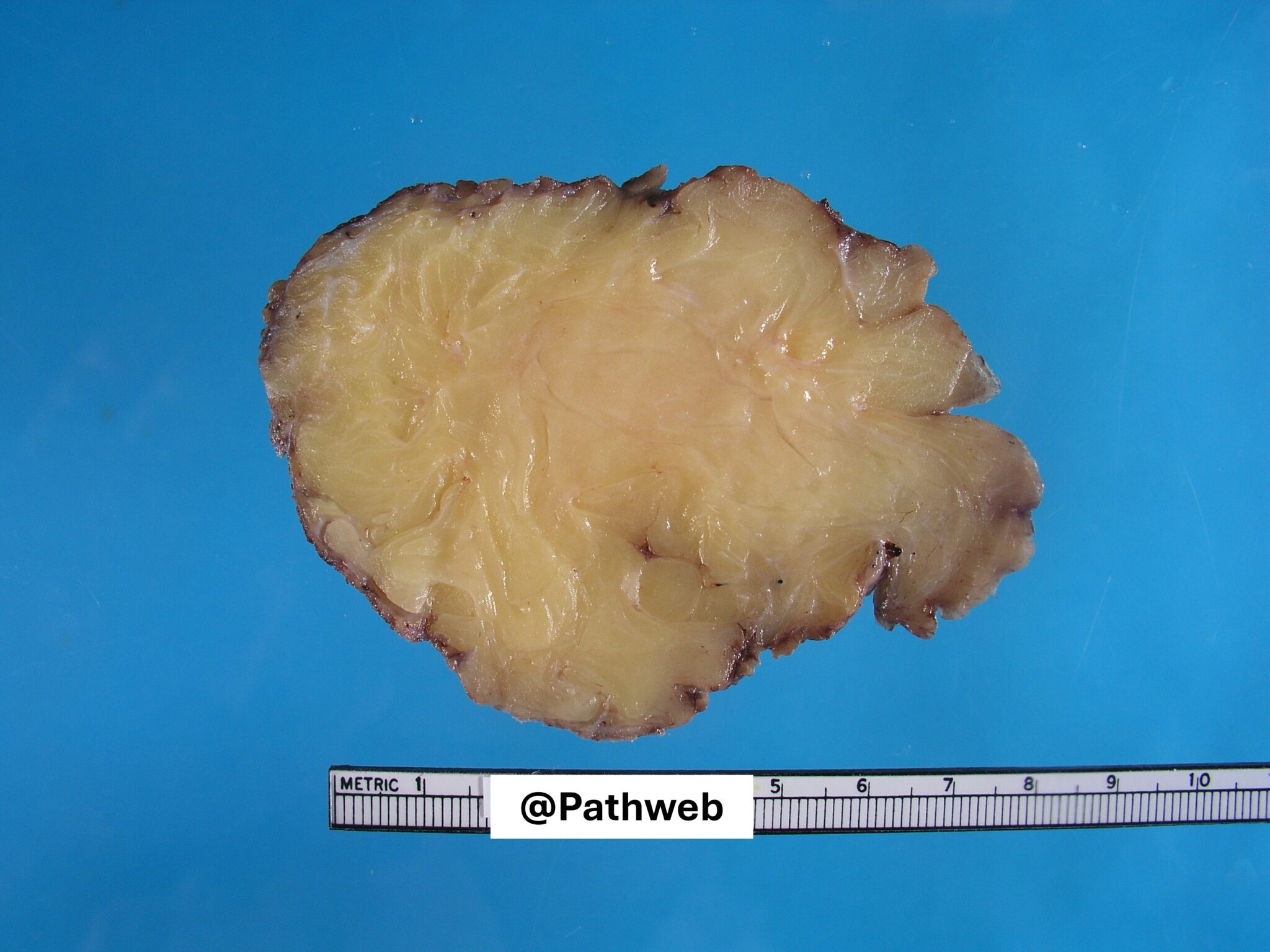Skin(Thigh) – Lipoma – NUS Pathweb :: NUS Pathweb
