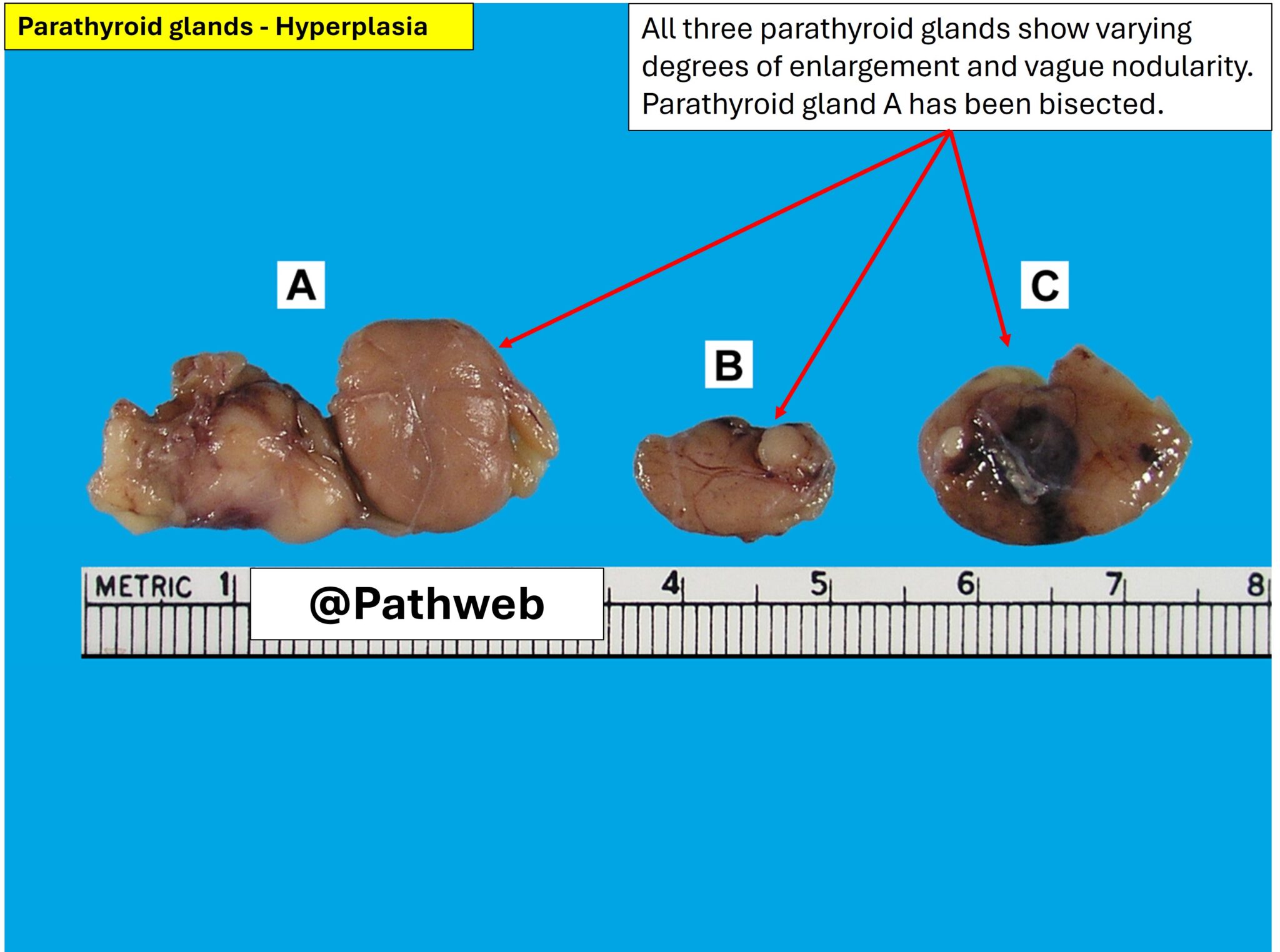 Parathyroid – Hyperplasia – NUS Pathweb :: NUS Pathweb