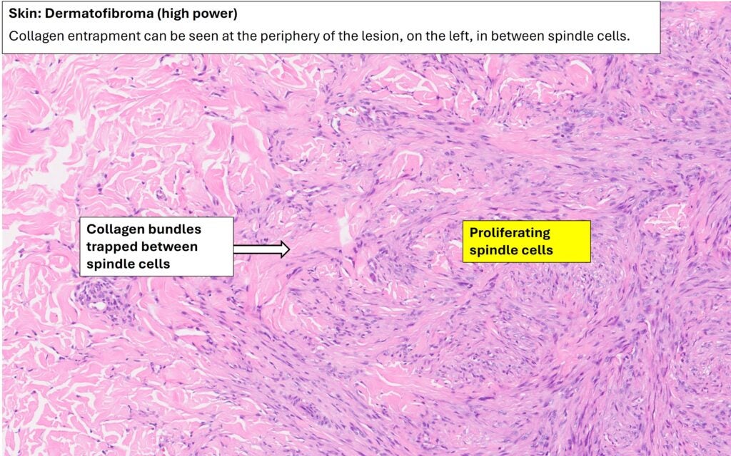 Skin – Dermatofibroma – NUS Pathweb :: NUS Pathweb