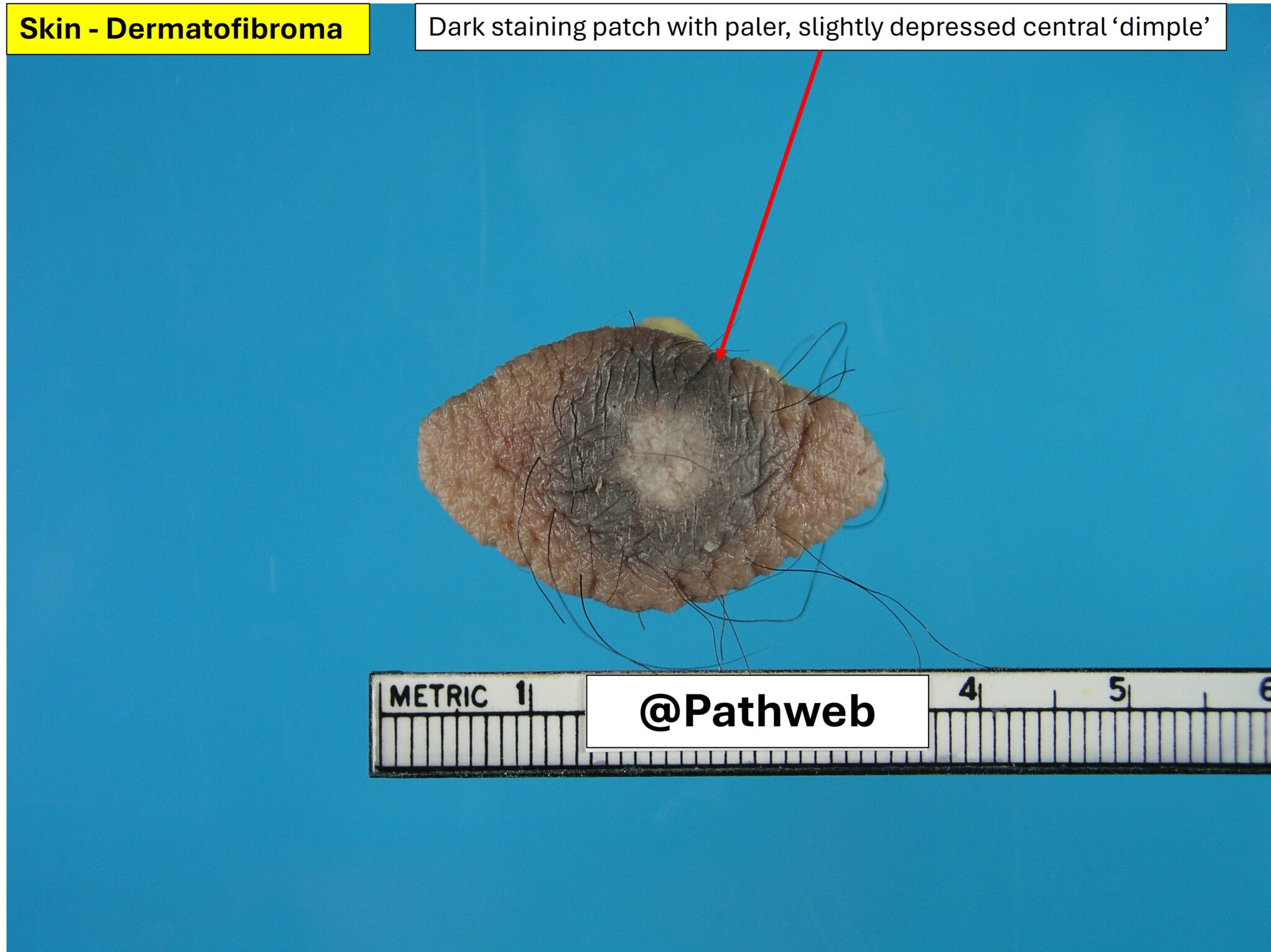 Skin – Dermatofibroma – NUS Pathweb :: NUS Pathweb