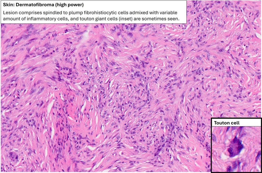 Skin – Dermatofibroma – NUS Pathweb :: NUS Pathweb