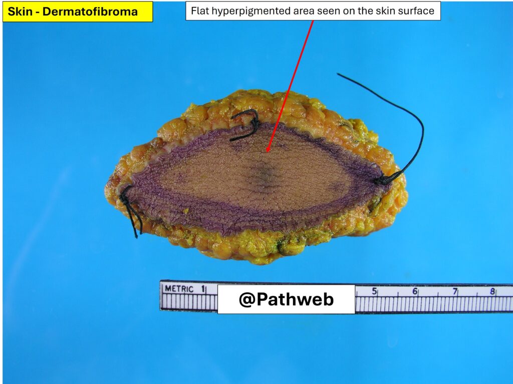 Skin – Dermatofibroma – NUS Pathweb :: NUS Pathweb
