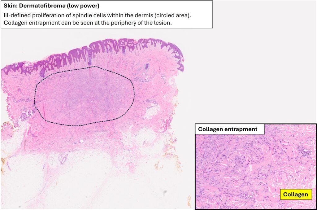 Skin – Dermatofibroma – NUS Pathweb :: NUS Pathweb