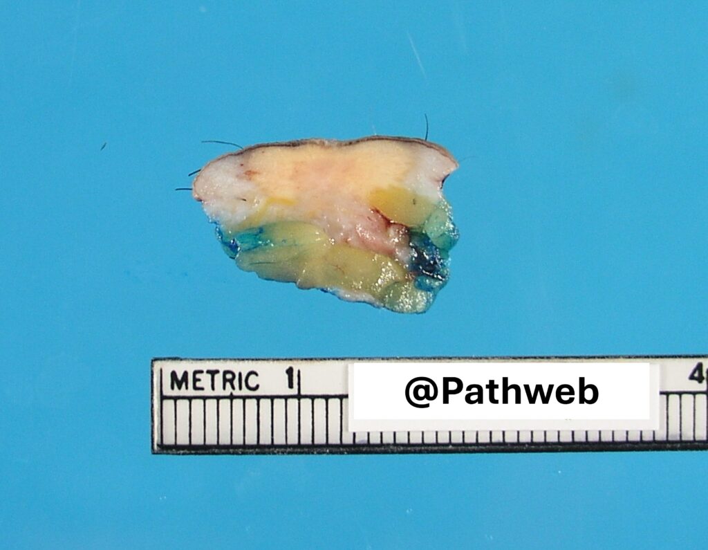 Skin – Dermatofibroma – NUS Pathweb :: NUS Pathweb