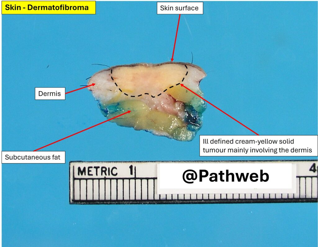 Skin – Dermatofibroma – NUS Pathweb :: NUS Pathweb