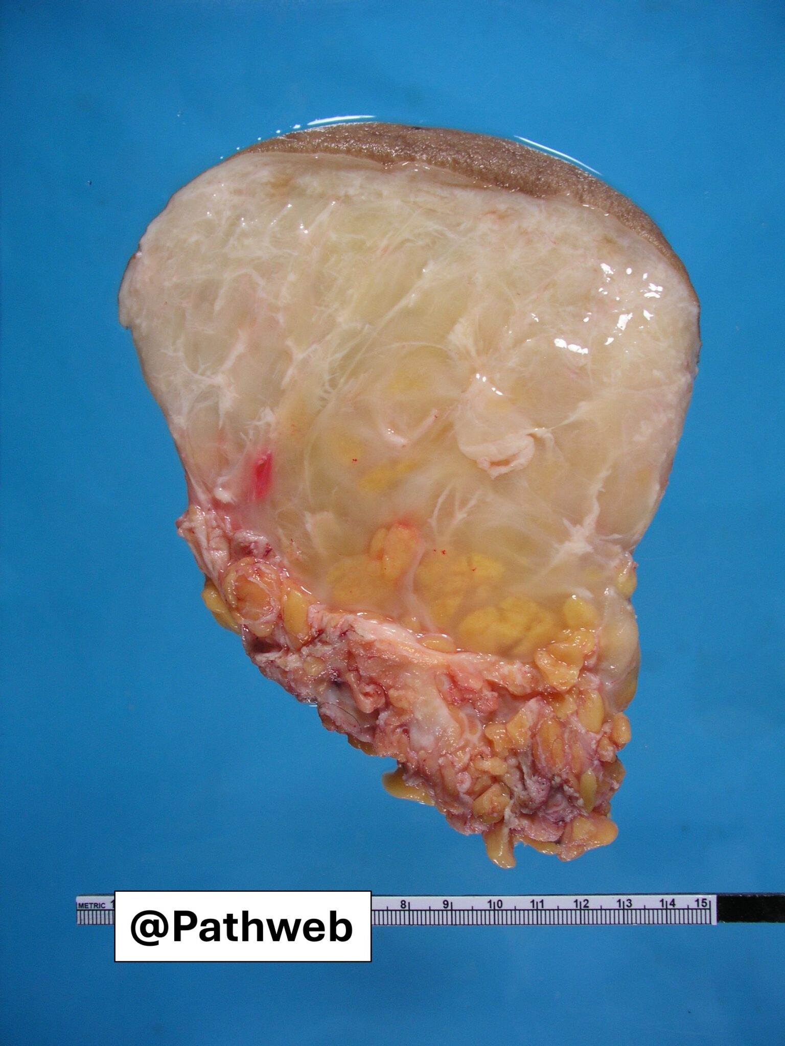 Scrotum – Elephantiasis – NUS Pathweb :: NUS Pathweb