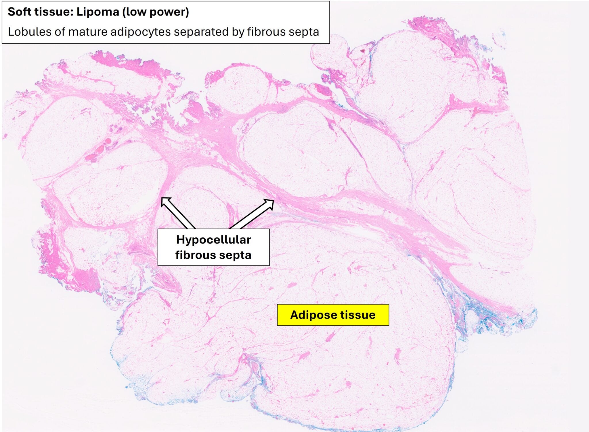 Skin – Lipoma – NUS Pathweb :: NUS Pathweb