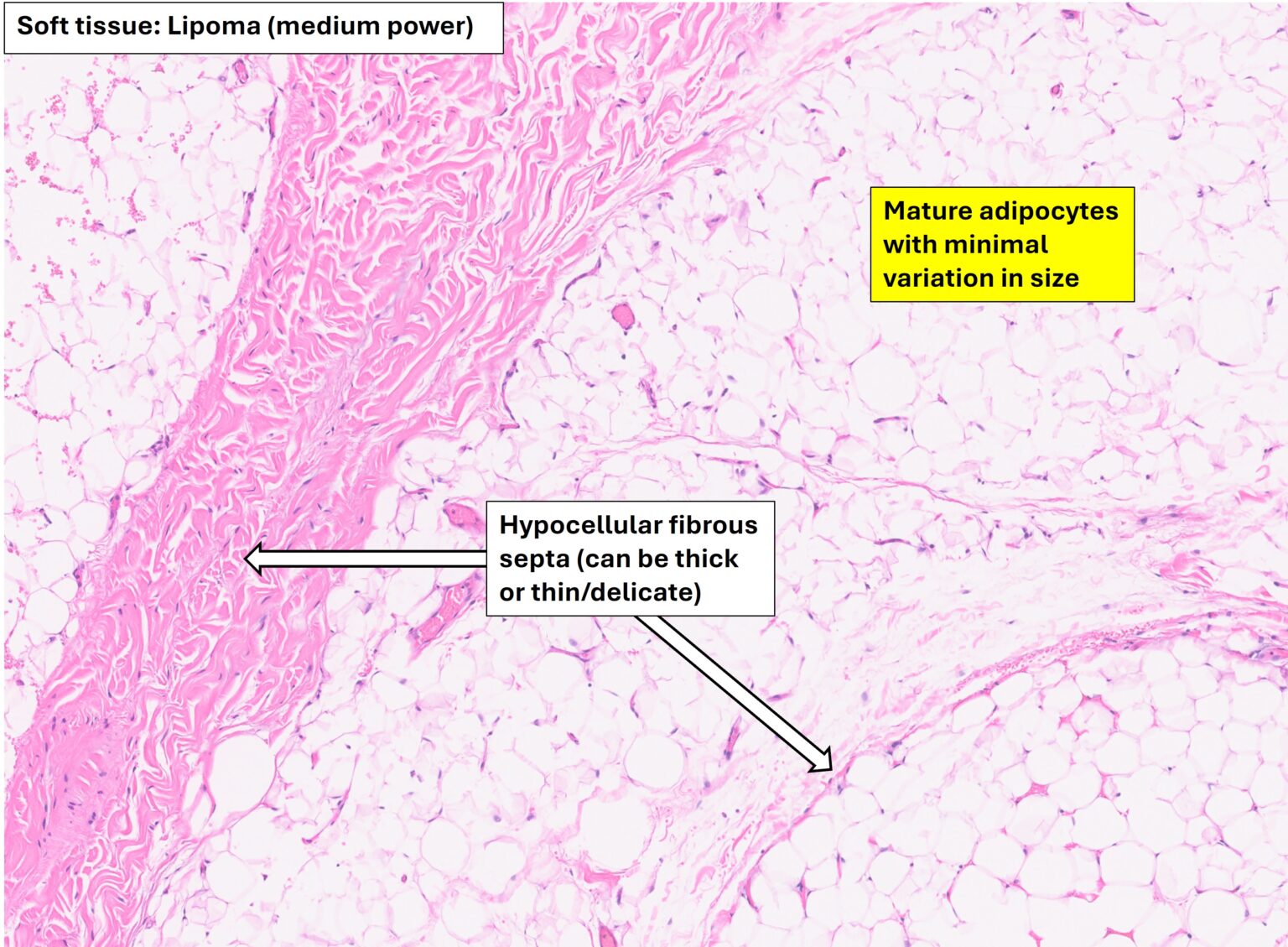 Skin – Lipoma – NUS Pathweb :: NUS Pathweb