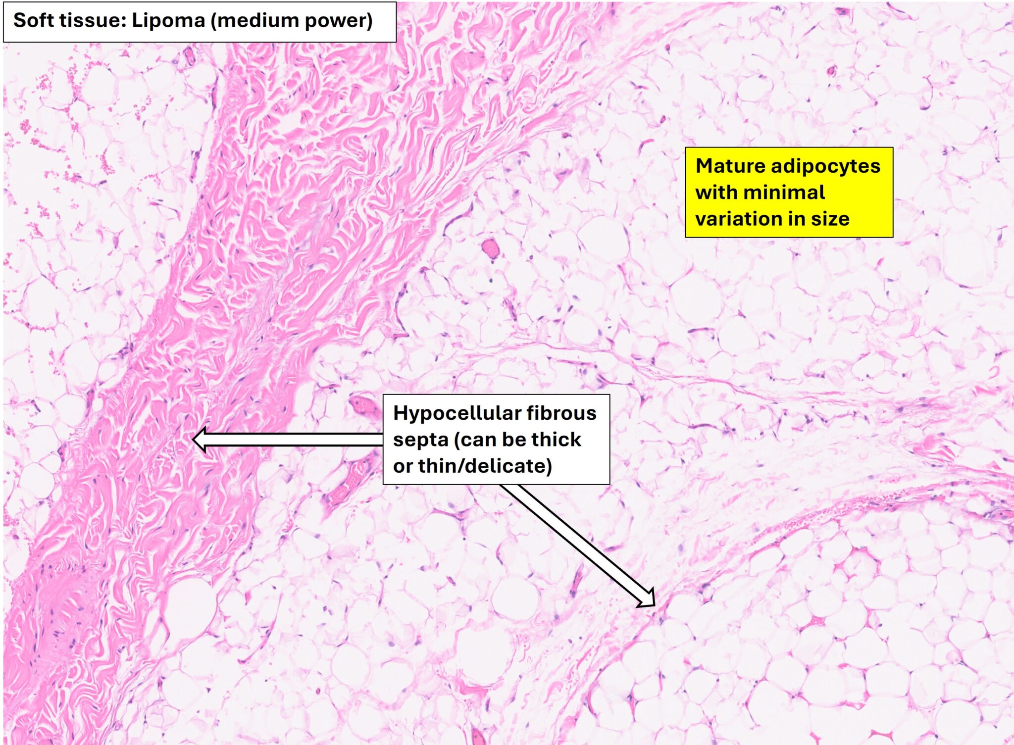 Skin – Lipoma – NUS Pathweb :: NUS Pathweb