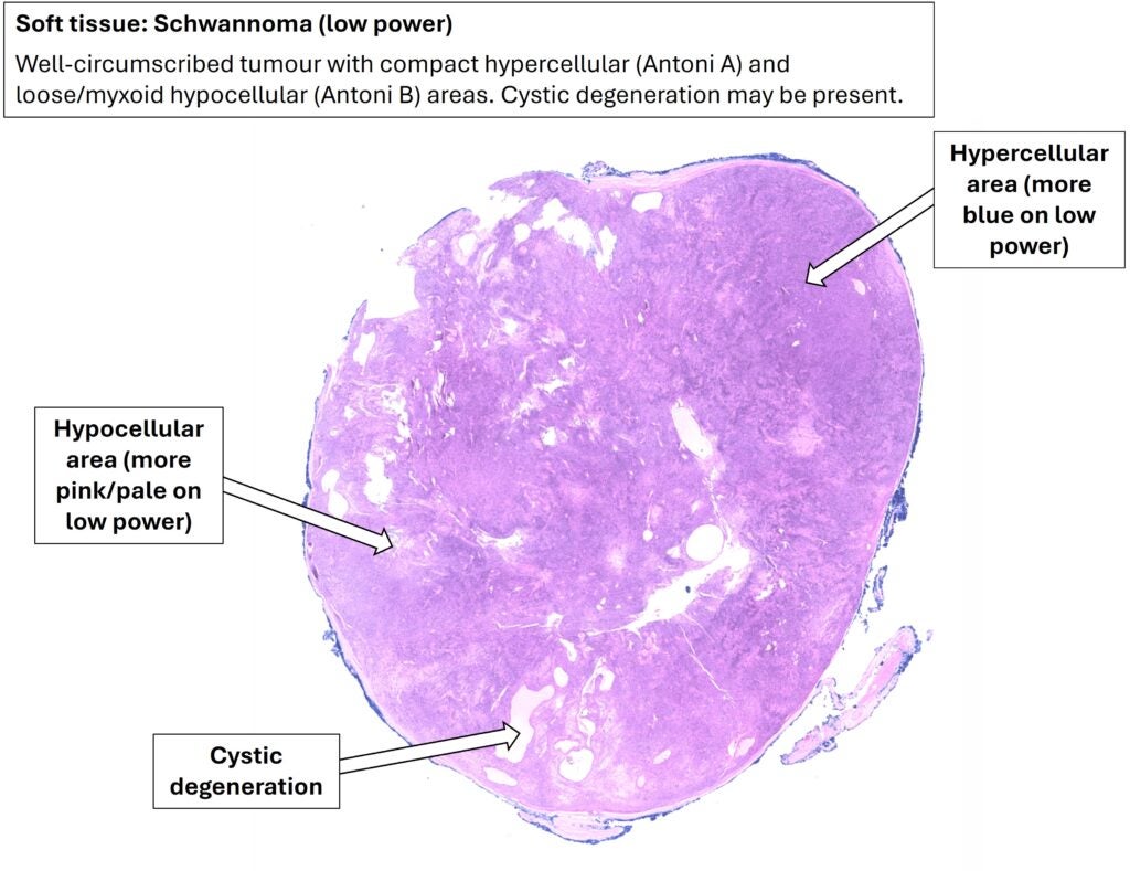 Brachial Plexus – Schwannoma – NUS Pathweb :: NUS Pathweb