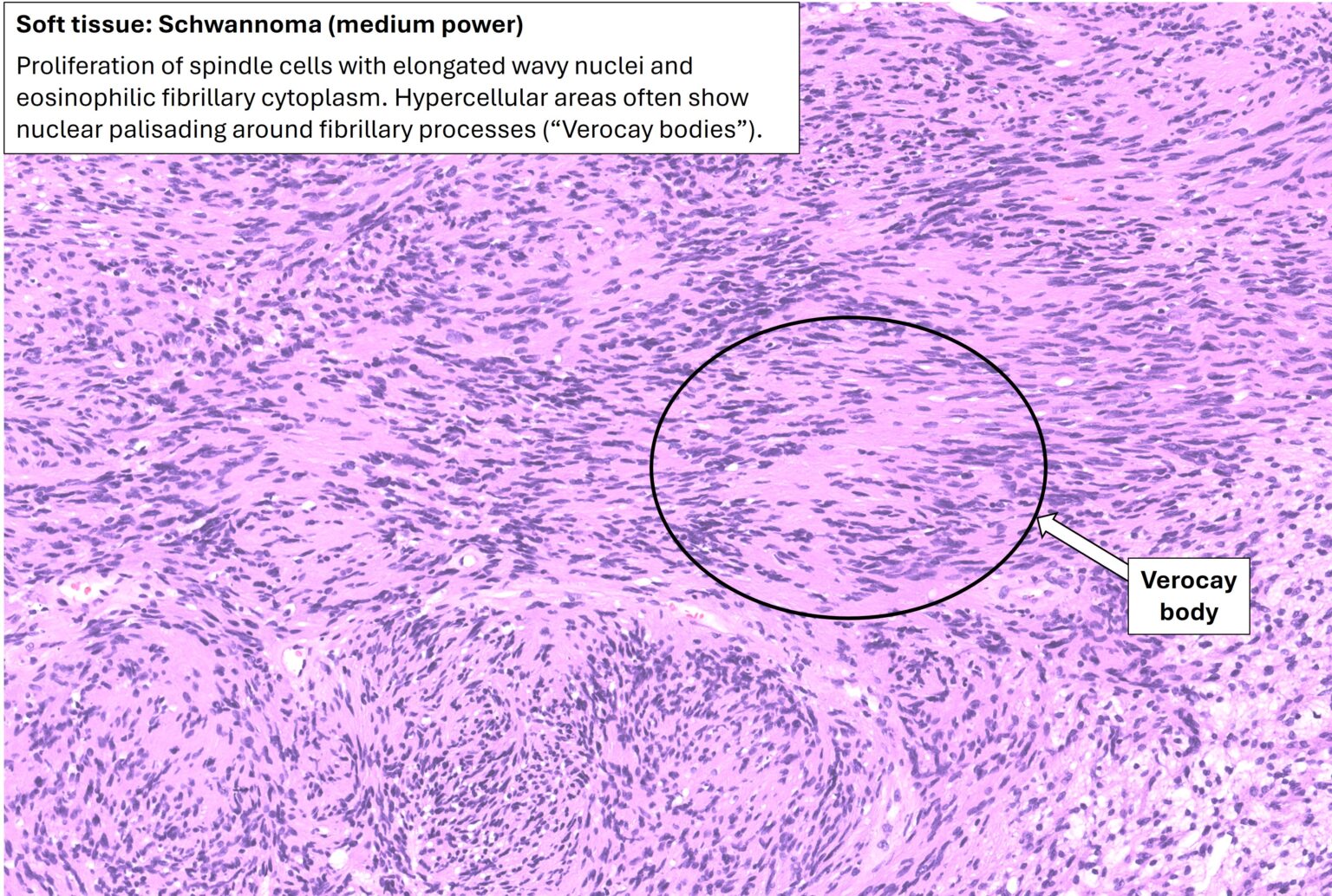 Nerve – Schwannoma(Neurilemmoma) – NUS Pathweb :: NUS Pathweb